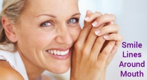 Smile Lines Around Mouth- Causes and Treatments - Look Young Clinic