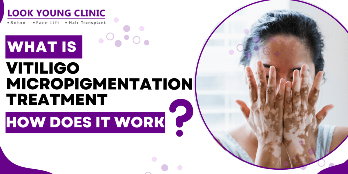 What is Vitiligo Micropigmentation Treatment- How Does It Work?